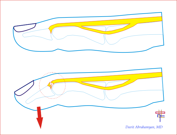 Mallet vinger - fysiotherapie Balans
